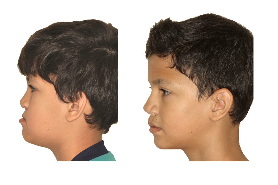 Orthodontist – Less Chin