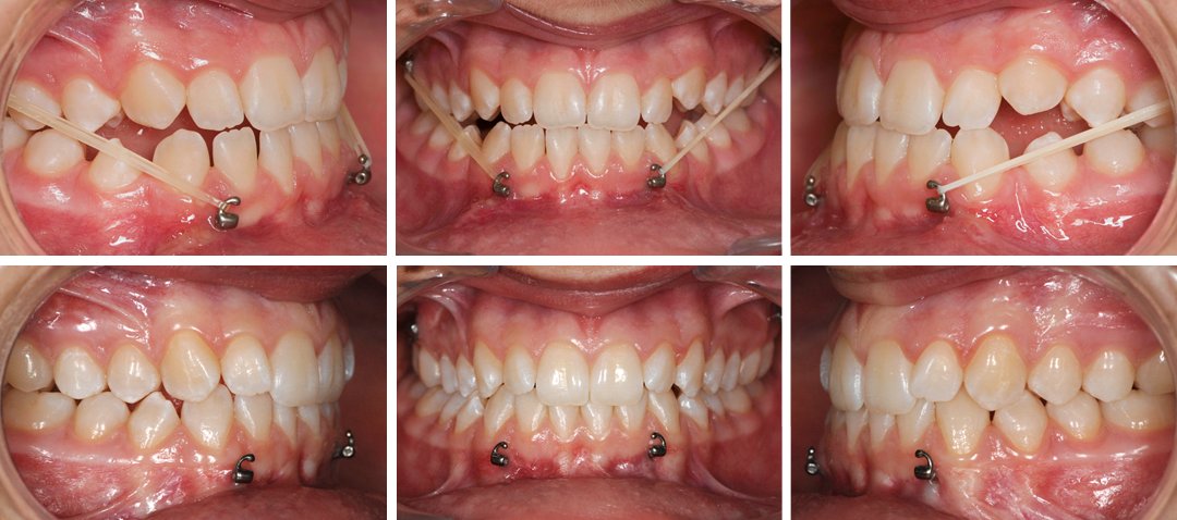 Patient – Less Chin